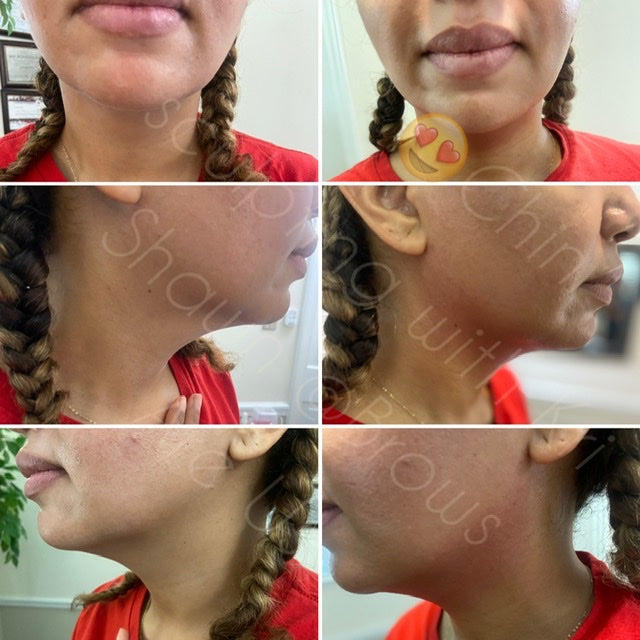 Double Chin Contouring- Raleigh, Burlington, Charlotte | NCBodyMetrics